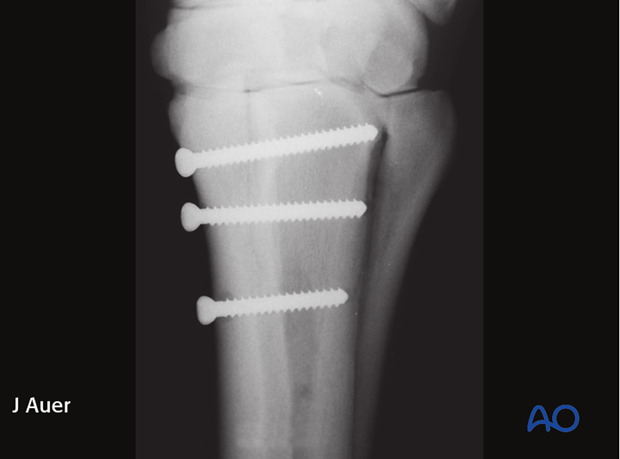 Fixation with lag screw for Metacarpals/-tarsals III: Proximal ...