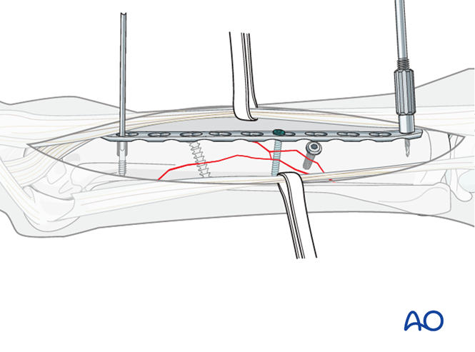Double/single plating for Metacarpals/-tarsals III: Diaphyseal ...