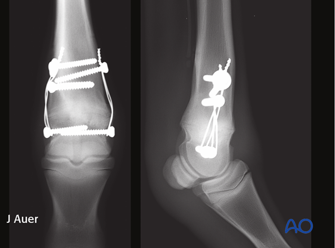 Screws with transphyseal bridge for Metacarpals/-tarsals III ...