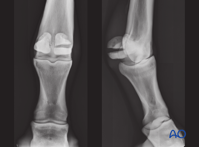 Proximal sesamoid bones: Abaxial fractures