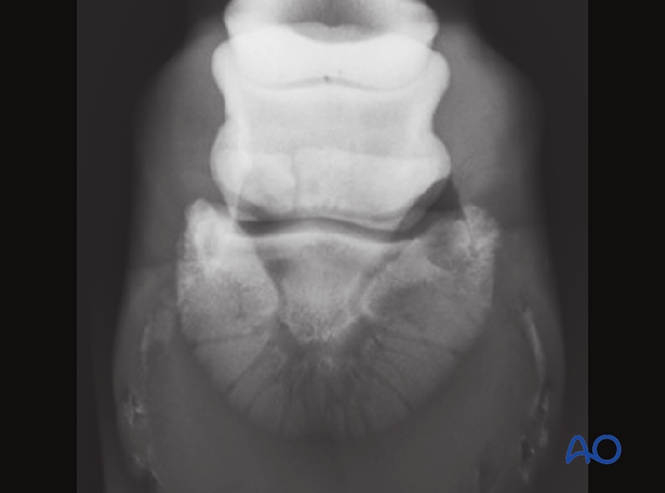 Nonsurgical management for Distal sesamoid bones fractures