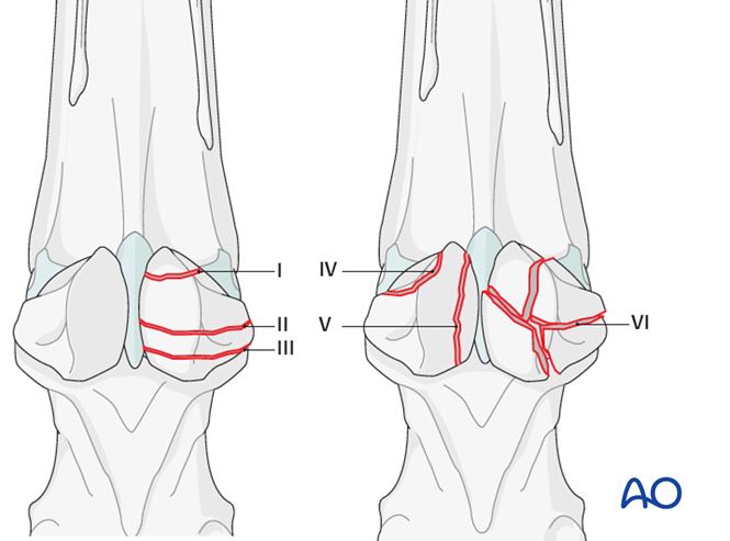 Proximal sesamoid bones: Abaxial fractures