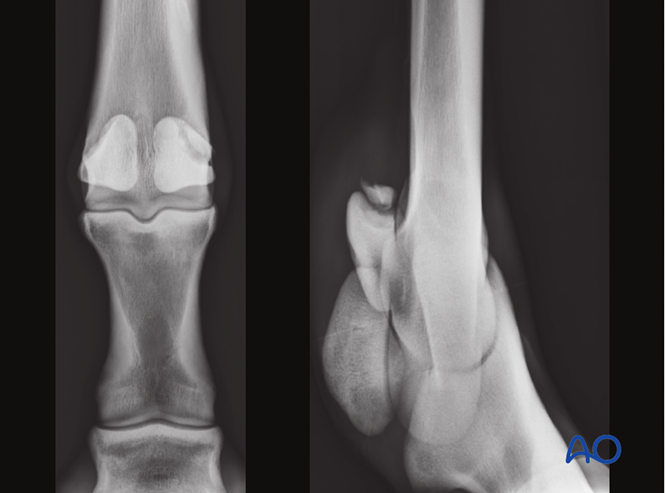 Proximal sesamoid bones: Abaxial fractures