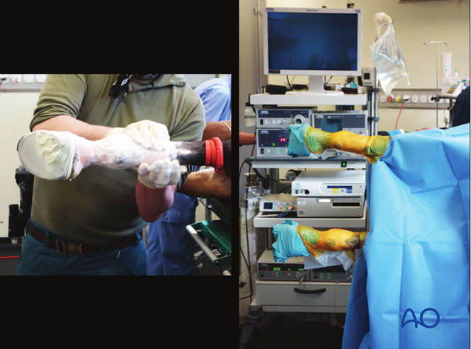 Preparation proximal sesamoids