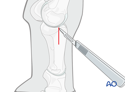 Screw fixation for Proximal phalanx: Complete uniarticular fractures
