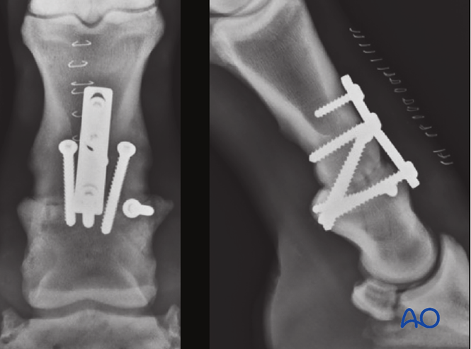 Fixation with a DCP or LC-DCP