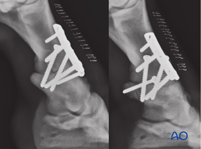 Fixation with a DCP or LC-DCP