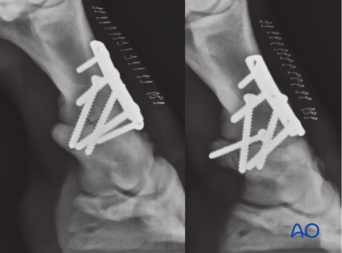 Fixation with a DCP or LC-DCP