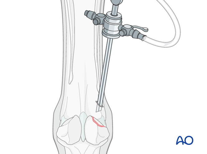 Fragment removal for Proximal sesamoid bones: Abaxial fractures