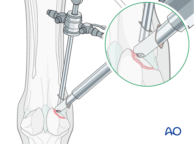 Fragment removal for Proximal sesamoid bones: Abaxial fractures