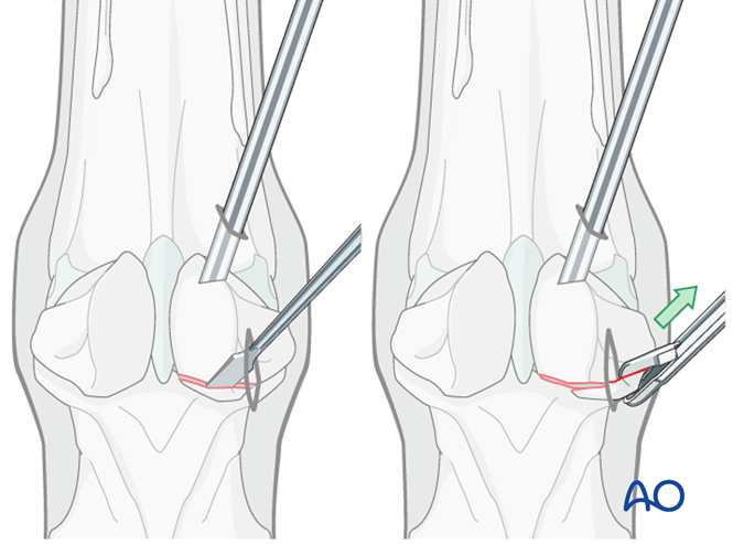 Fragment removal for Proximal sesamoid bones: Basilar fractures