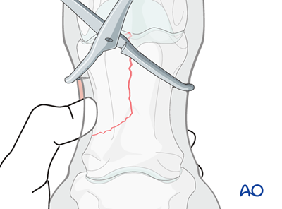 Screw fixation for Proximal phalanx: Complete uniarticular fractures
