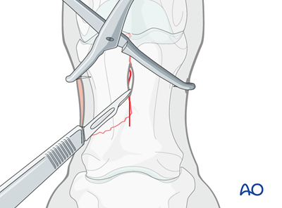 Screw fixation for Proximal phalanx: Complete uniarticular fractures