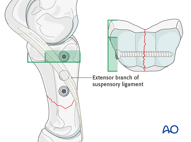 Screw fixation for Proximal phalanx: Complete uniarticular fractures