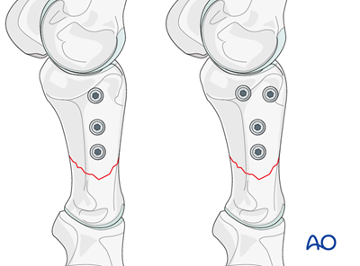 Screw fixation for Proximal phalanx: Complete uniarticular fractures