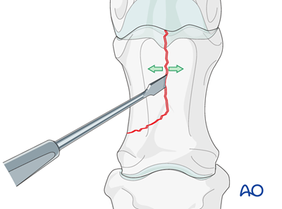 Screw fixation for Proximal phalanx: Complete uniarticular fractures