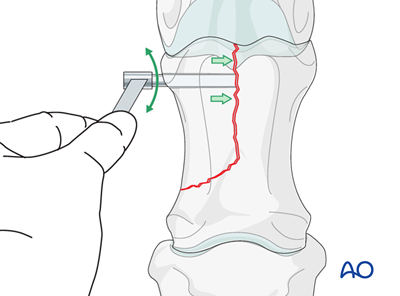 Screw fixation for Proximal phalanx: Complete uniarticular fractures
