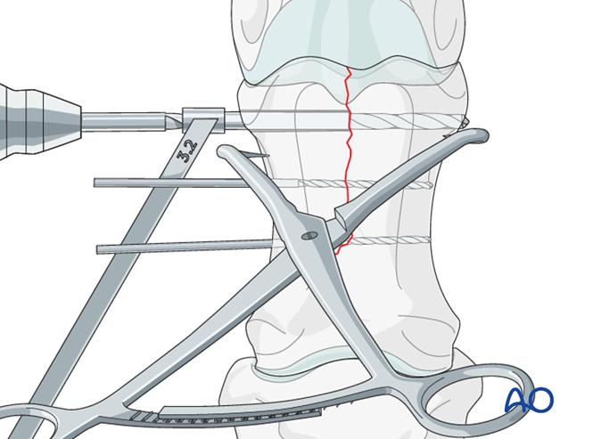 Screw fixation for Proximal phalanx: Complete uniarticular fractures
