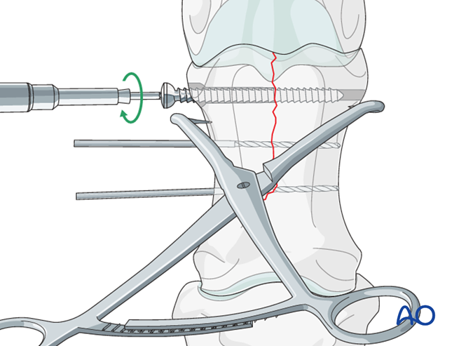 Screw fixation for Proximal phalanx: Complete uniarticular fractures