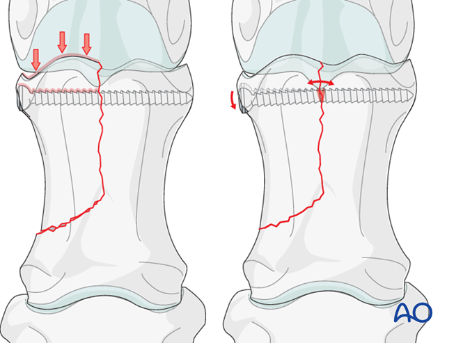 Screw fixation for Proximal phalanx: Complete uniarticular fractures