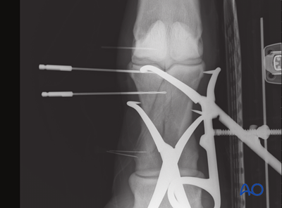 Screw fixation for Proximal phalanx: Complete uniarticular fractures