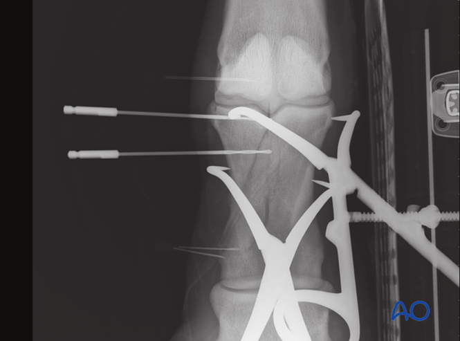 Screw fixation for Proximal phalanx: Complete uniarticular fractures