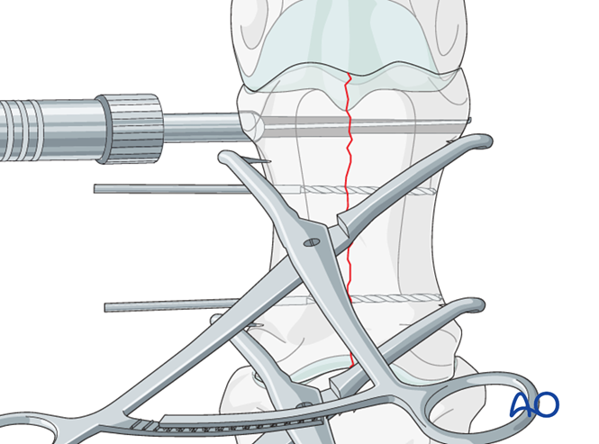 Screw fixation for Proximal phalanx: Complete biarticular fractures