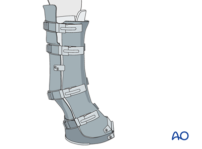 Screw fixation for Proximal phalanx: Complete uniarticular fractures