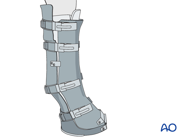 Screw fixation for Proximal phalanx: Complete uniarticular fractures
