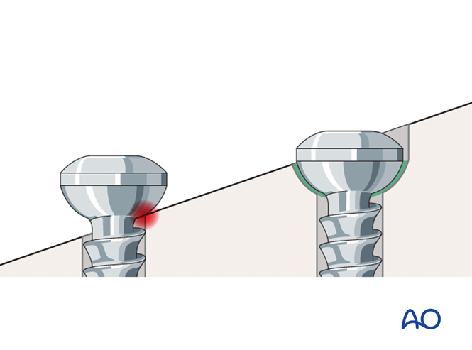 Screw fixation for Proximal phalanx: Complete uniarticular fractures
