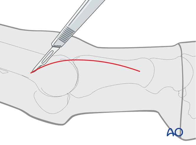 Approach for comminuted and transverse body fractures of the equine ...