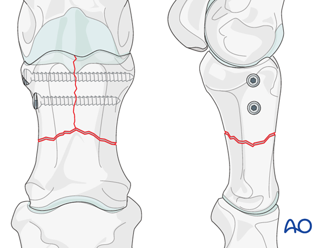Double-plate fixation for Proximal phalanx: Transverse body fractures