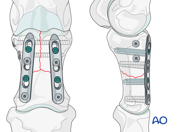 Double-plate fixation for Proximal phalanx: Transverse body fractures