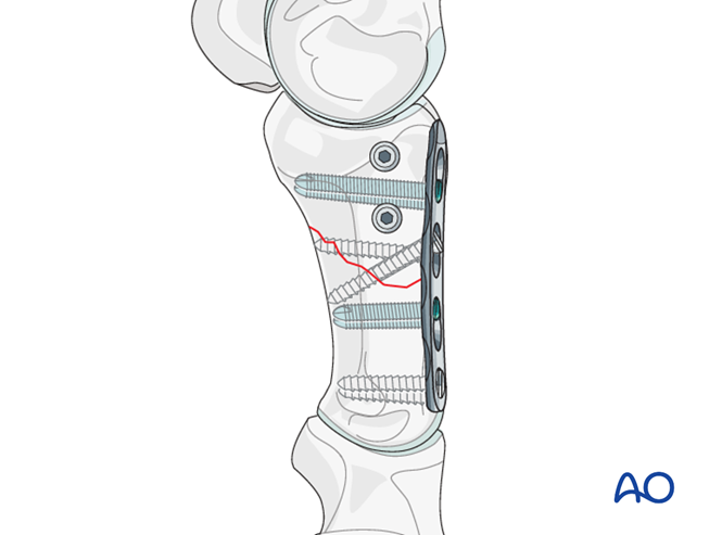 Double-plate fixation for Proximal phalanx: Transverse body fractures