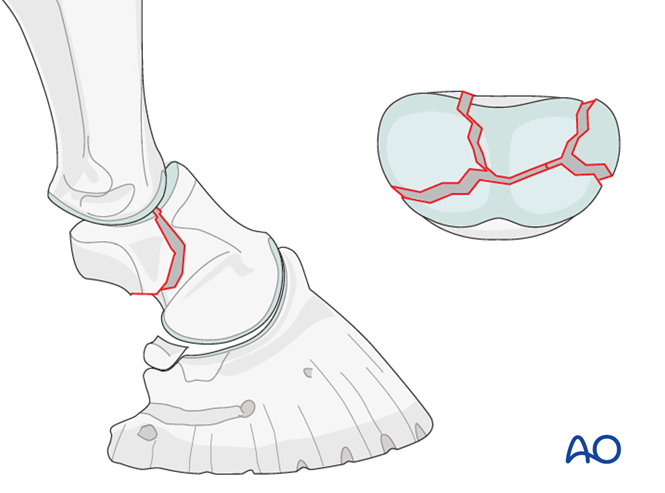 Middle phalanx: Multifragmentary fractures