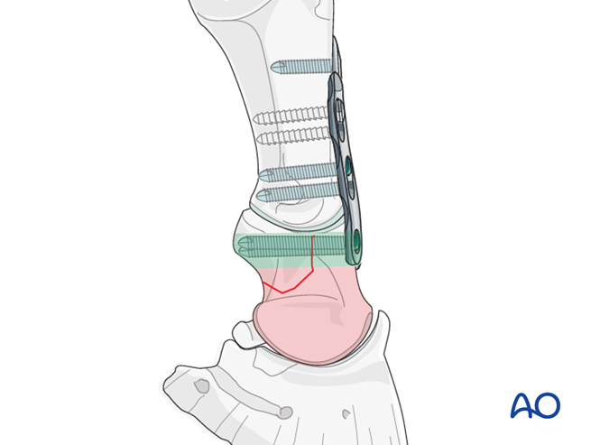 Double-plate fixation for Middle phalanx: Multifragmentary fractures
