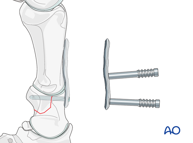 Double-plate fixation for Middle phalanx: Multifragmentary fractures