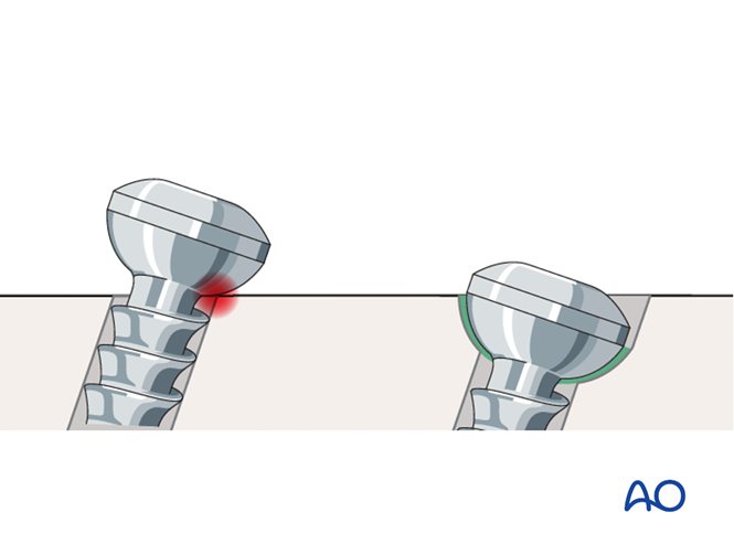 Plate fixation/transarticular lag screws for Middle phalanx ...