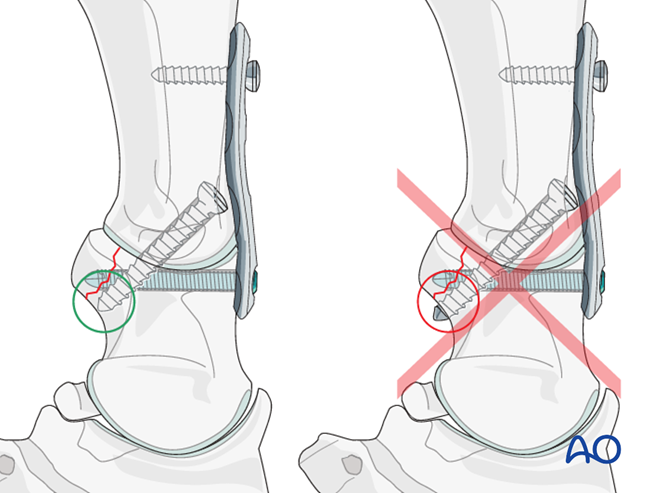 Plate fixation/transarticular lag screws for Middle phalanx ...