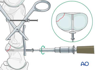 Fixation with a DCP or LC-DCP