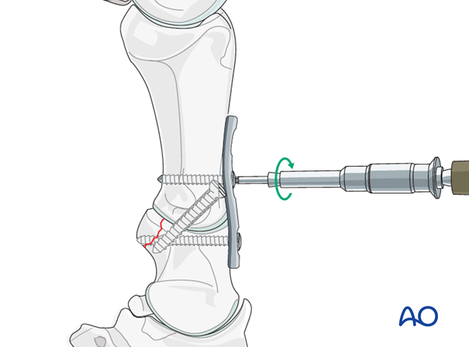 Fixation with a DCP or LC-DCP