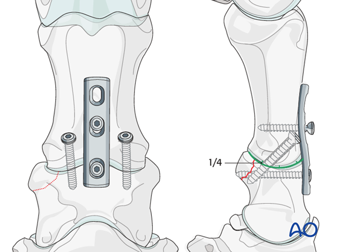 Fixation with a DCP or LC-DCP