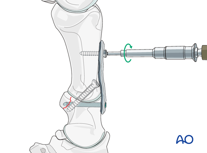 Plate fixation/transarticular lag screws for Middle phalanx: Dorsal ...