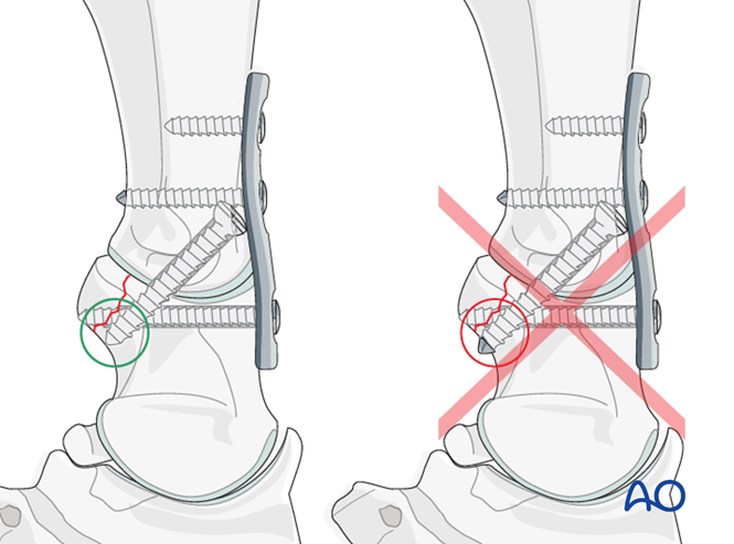Fixation with a DCP or LC-DCP