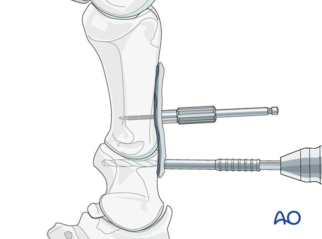 Plate fixation/transarticular lag screws for Middle phalanx ...
