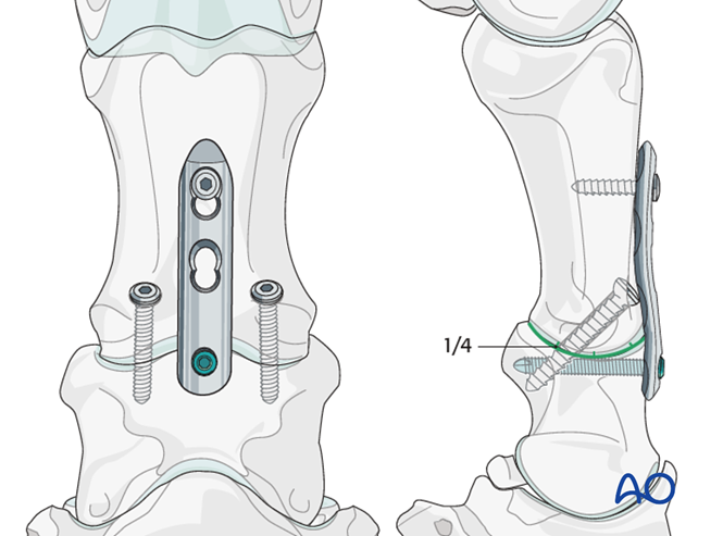 Plate fixation/transarticular lag screws for Middle phalanx ...