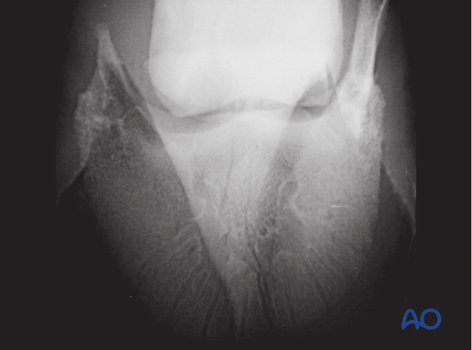 Distal phalanx: Solar margin fractures
