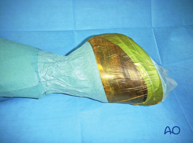 Fragment removal for Proximal sesamoid bones: Basilar fractures