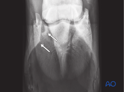 Nonsurgical management for Distal phalanx: Extensor process fractures