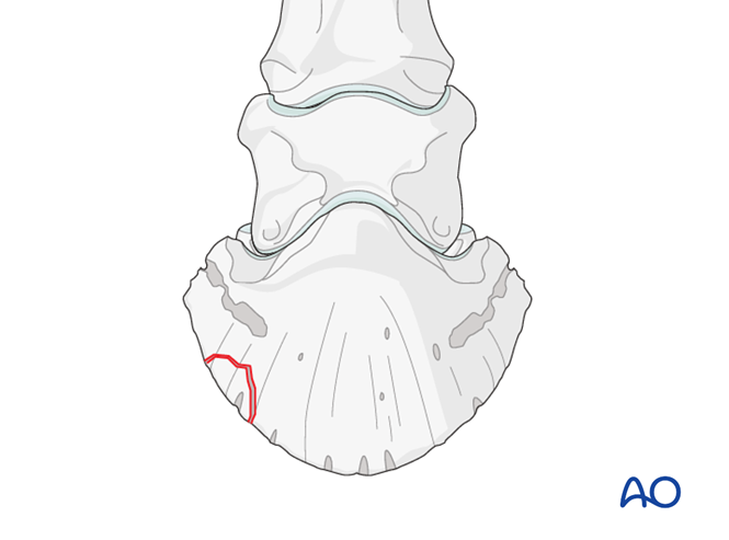 Distal phalanx: Solar margin fractures